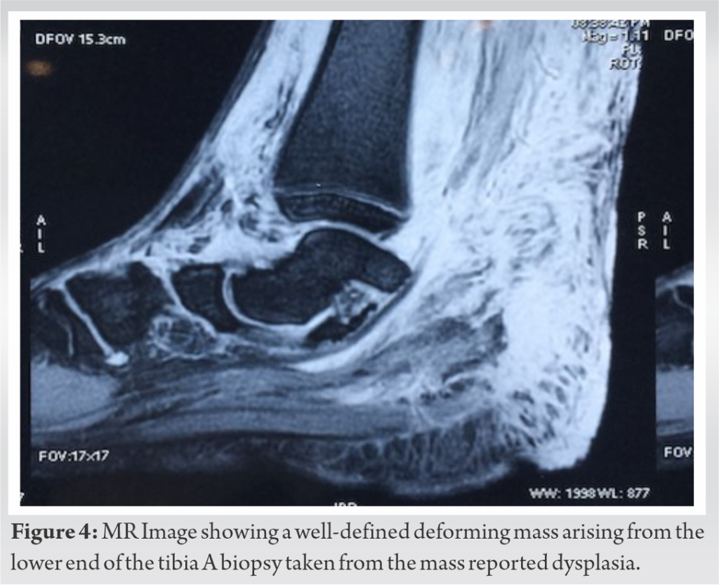 Tibial Dysplasia in Neurofibromatosis-1: A Rare Case Report and Review ...