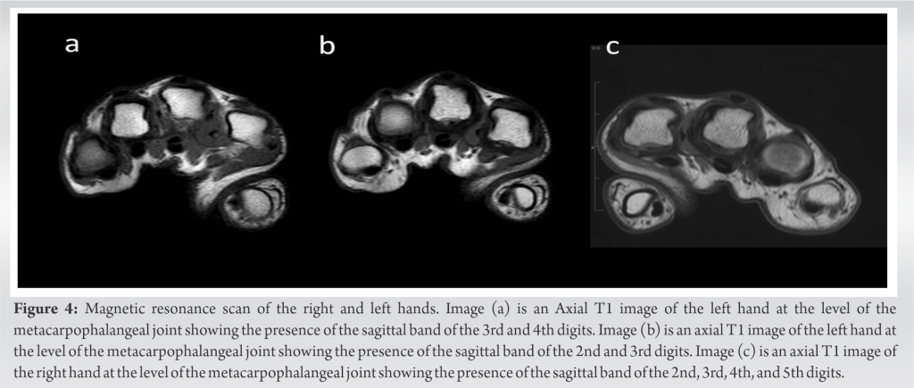 Spontaneous Idiopathic Bilateral Sagittal Band Rupture: A Case Report ...