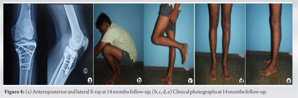 A Unique Upside-down Flip-lid Type of Lateral Tibial Plateau Fracture ...