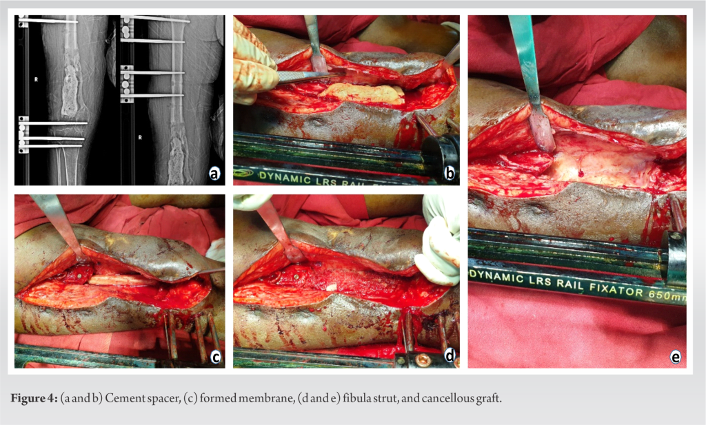 Management of Infected Gap Non-union of Distal Femur with Induced ...
