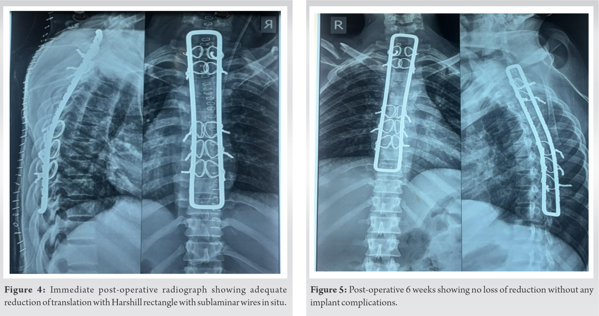 Use of Hartshill Rectangle with Sublaminar Wiring in Spinal ...