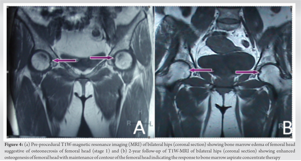 Core Decompression with Bone Marrow Aspirate Concentrate Implantation ...