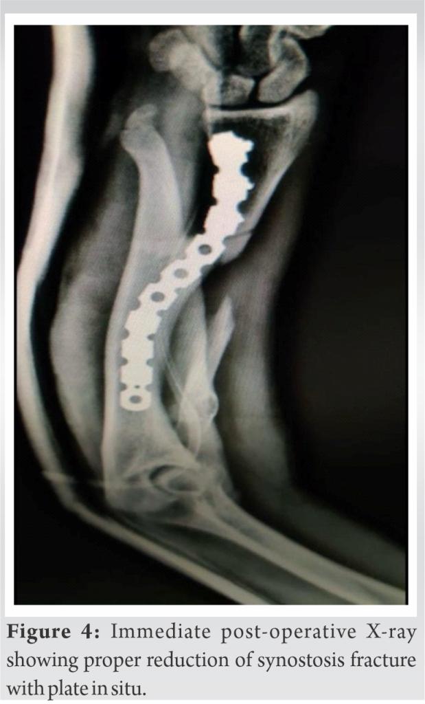 Management of Congenital Radioulnar Synostosis Fracture Following Road ...