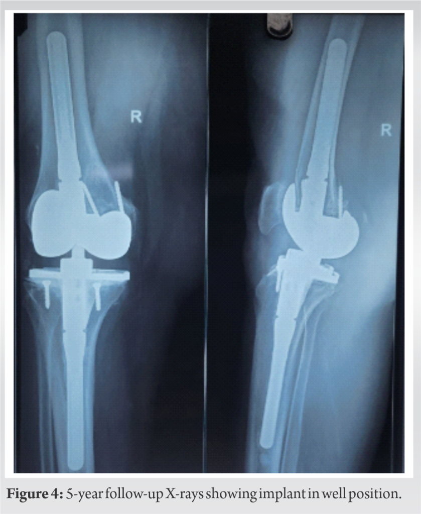 A Case of Varus Collapse and Bone Defects in Revision Total Knee ...