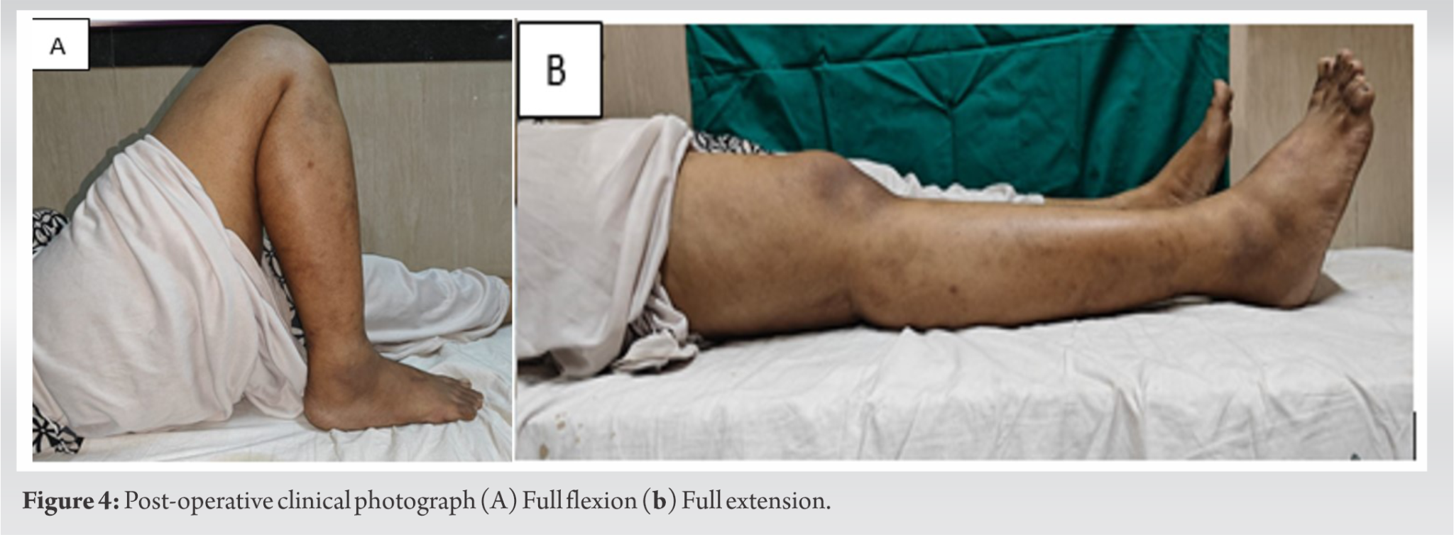 Posterior Cruciate Ligament Avulsion Fracture of Tibia: Fixation with ...