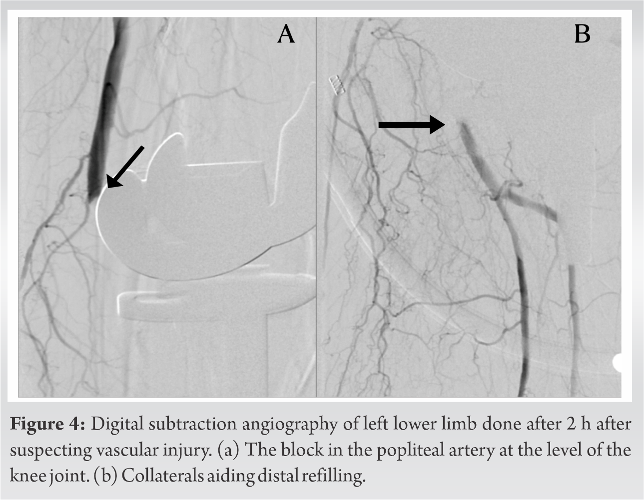 Vascular Injury during Total Knee Replacement and Check List to Follow ...