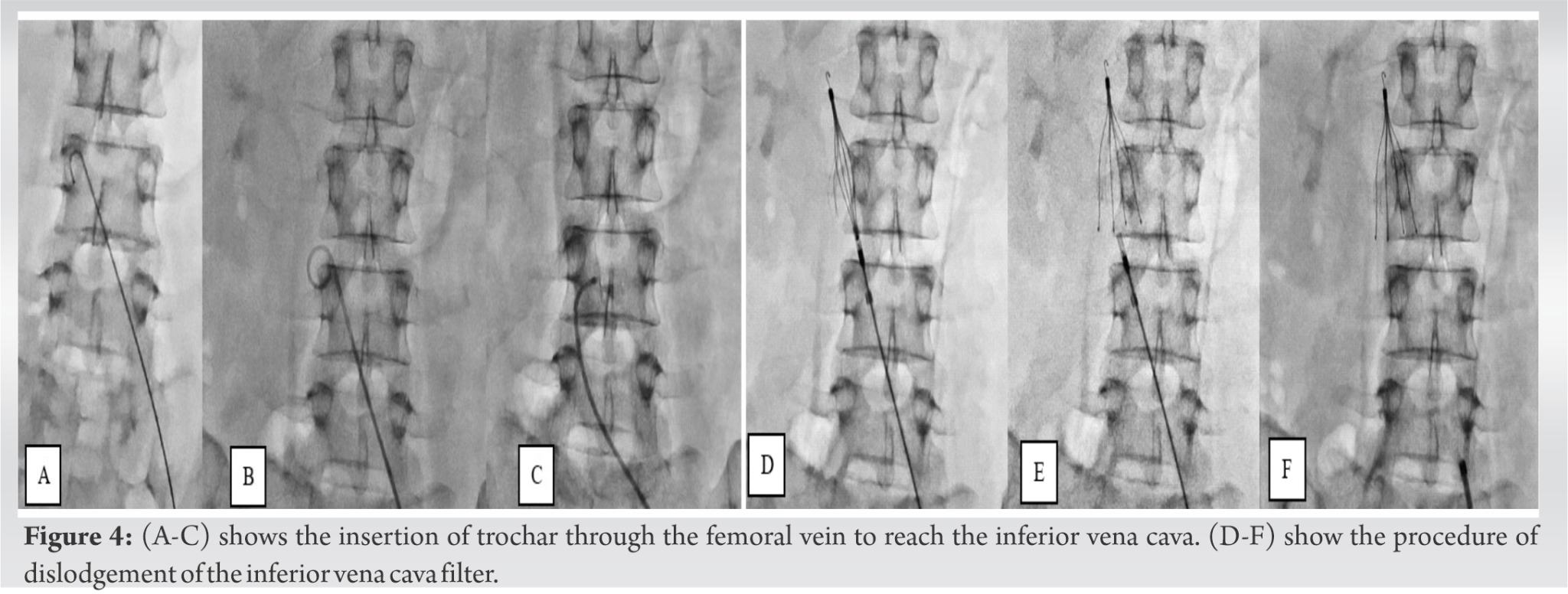 DVT with Pulmonary Embolism in Patient with Grade 2 Compound Tibia ...