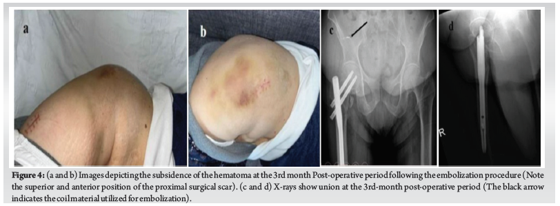 Pseudoaneurysm Formation in the Superior Gluteal Artery Following Short ...