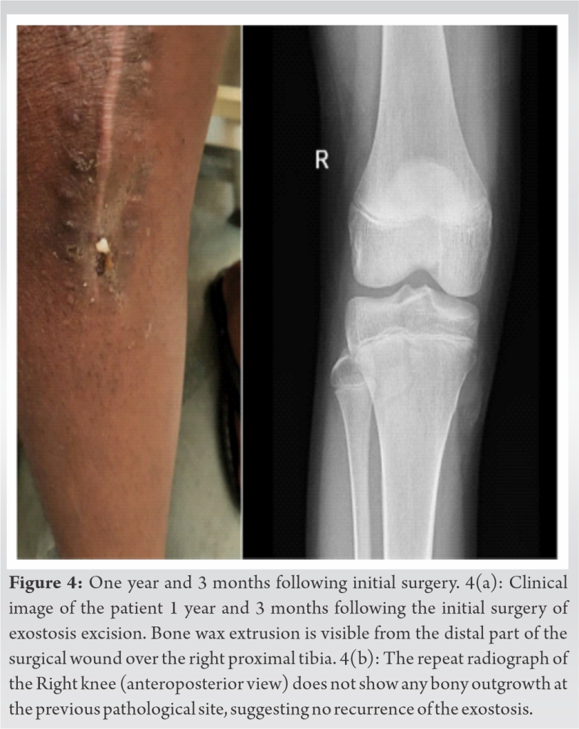 Beyond Hemostasis: Understanding the Risks of Bone Wax in Orthopedic ...