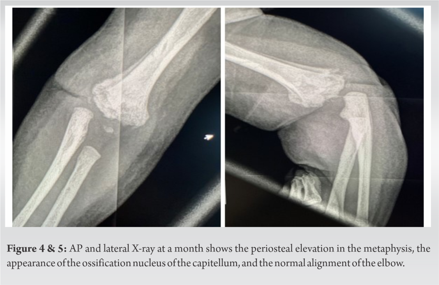 Neonatal Transphyseal Separation of the Distal Humeral Epiphysis: Early ...