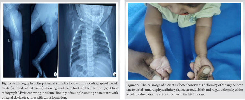 Bilateral Distal Humeral Physeal Separation-From Birth Trauma to Family ...