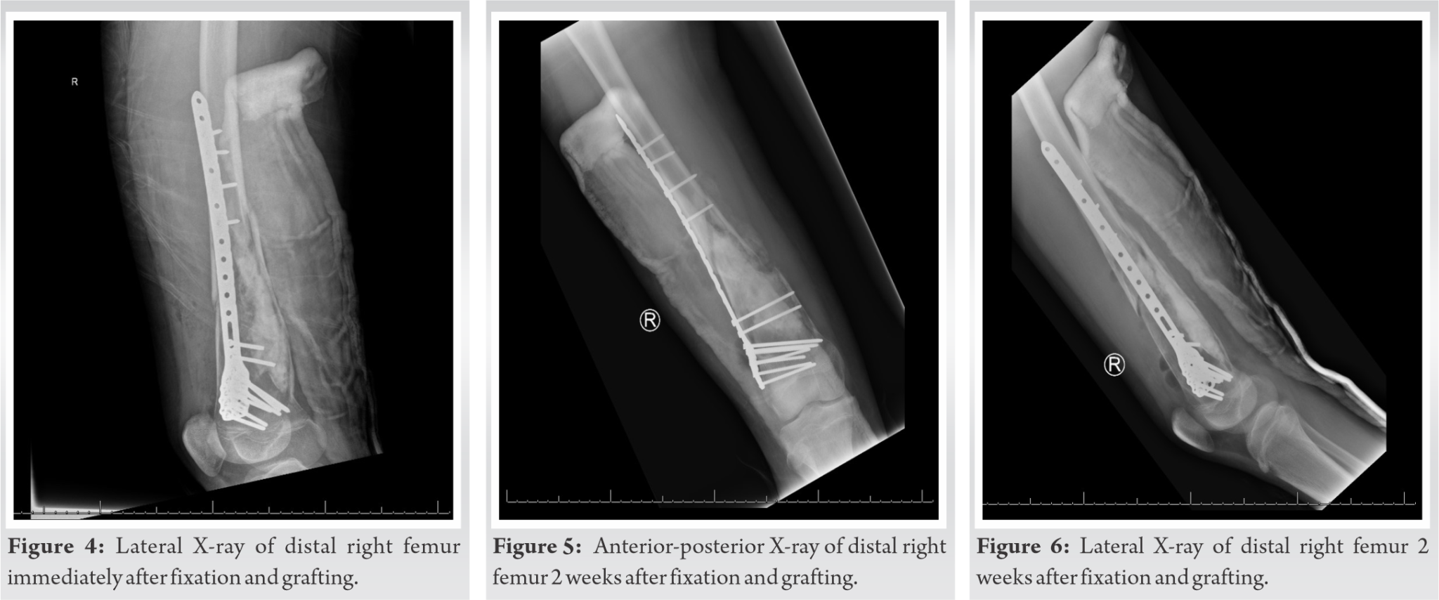 Operative Treatment of a Patient with a Pathological Fracture through a ...