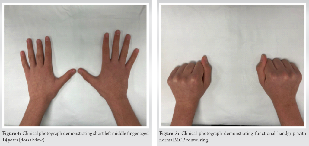 Digital Physeal Arrest Following Dactylitis in a Child | Journal of ...