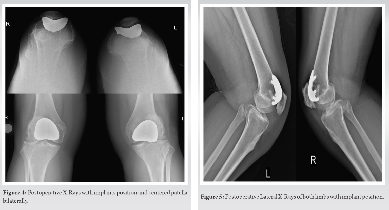 Patellofemoral Arthroplasty for Irreducible Chronic Bilateral Patella ...