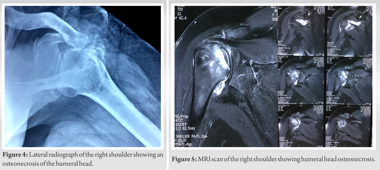 Osteonecrosis of the Humeral Head Following Arthroscopic Repair of ...
