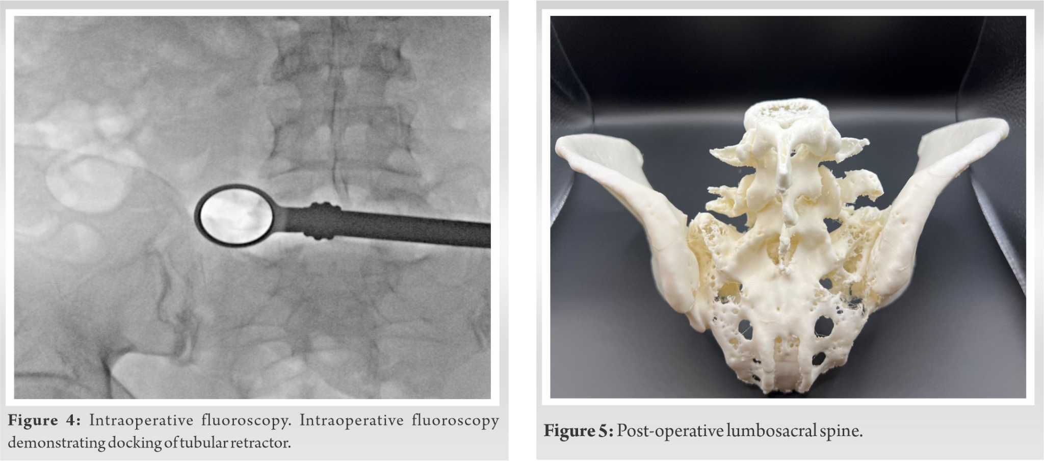 3D-Printed Spine Models for Planning Staged Minimally Invasive ...