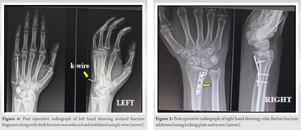 Bilateral Avulsion Fractures of Extensor Carpi Ulnaris: A Case Report ...