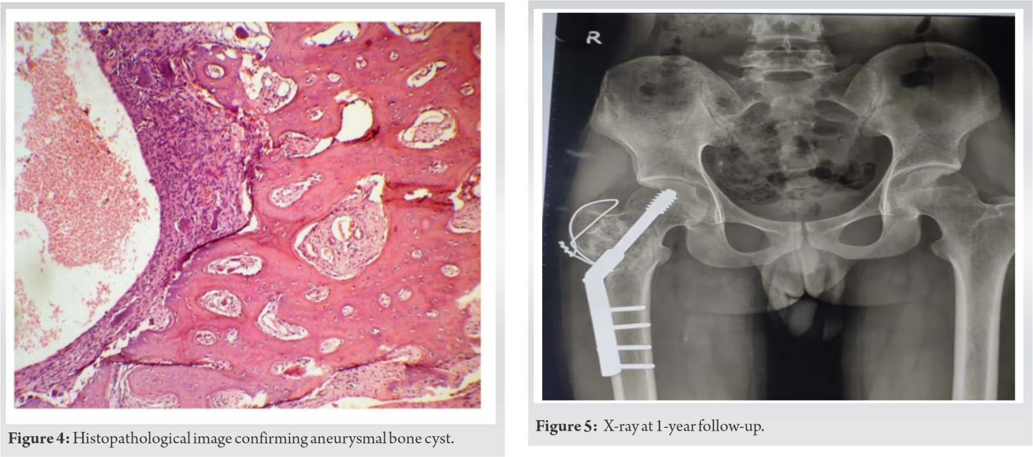 Management of Proximal Femur Aneurysmal Bone Cyst with 10-year Follow ...