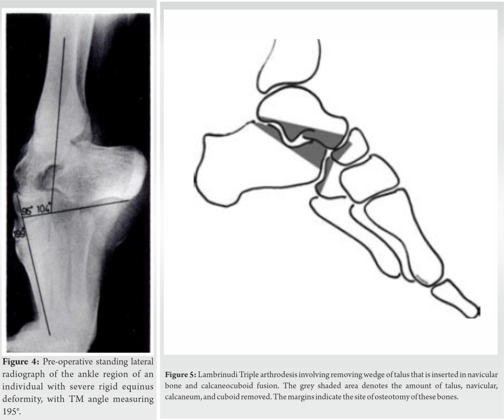 Lambrinudi Triple Arthrodesis with Posterior Tibial Tendon Transfer in ...