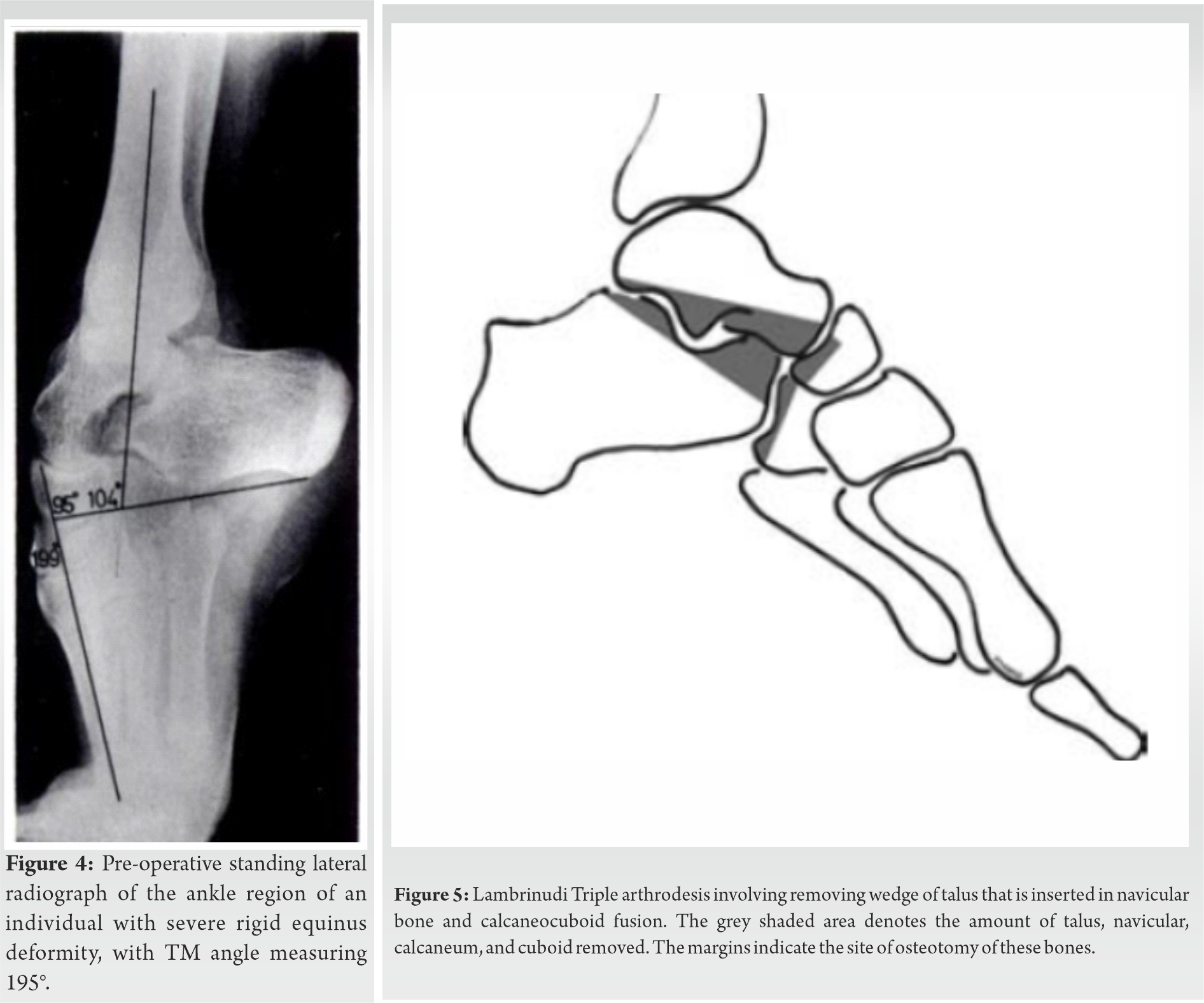 Lambrinudi Triple Arthrodesis with Posterior Tibial Tendon Transfer in ...