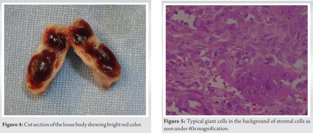 Giant Cell Tumor as a Rare Cause of Loose Bodies in the Knee Joint – A ...