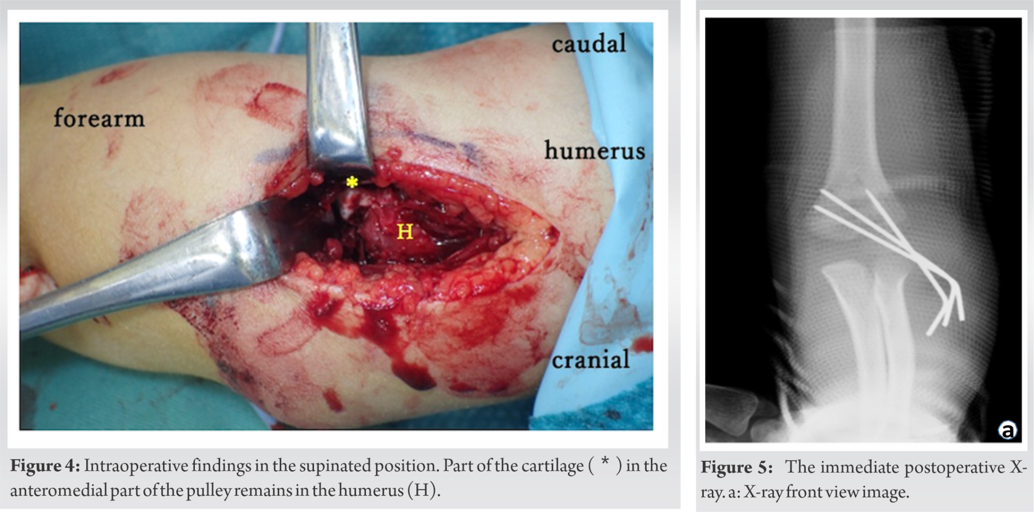 Case report: triplane fracture of distal humeral epiphysis diagnosed ...