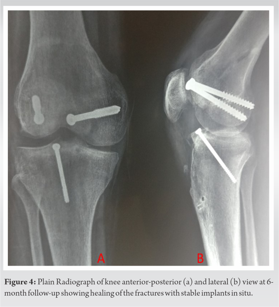 Open Non-conjoint Bicondylar Hoffa Fracture with Ipsilateral Tibial ...