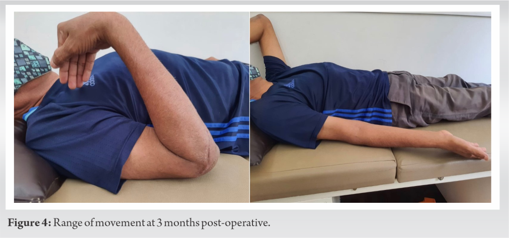 Complete Rupture of Common Extensor Origin of Elbow: A Rare Case Report ...
