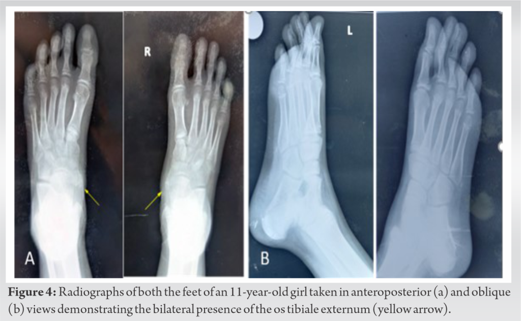 Beyond the obvious: Exploring Os Tibiale Externum and Os Peroneum in ...