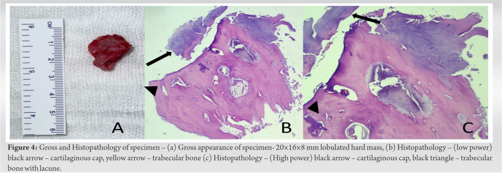 O-arm Navigated en bloc Excision of a Solitary Subaxial Cervical ...