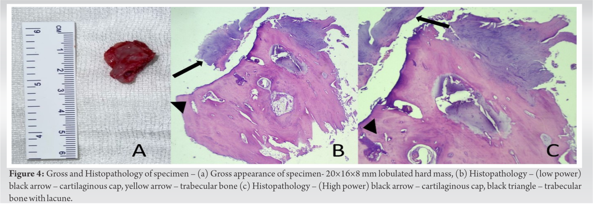 O-arm Navigated en bloc Excision of a Solitary Subaxial Cervical ...