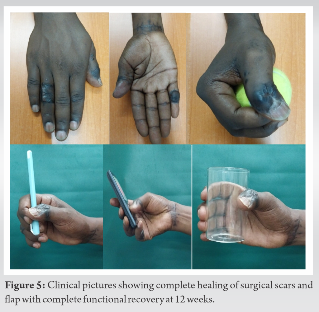 Management of Soft-tissue Defects of Hand in a Conflict Combat Zone: A ...