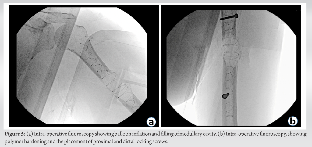 The Use of Photodynamic Bone Stabilization to Tamponade Bleeding in a ...