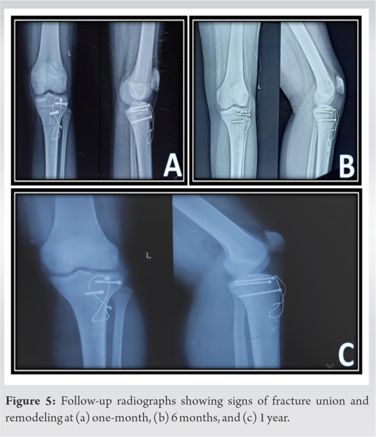 Tibial Tuberosity Avulsion Fracture with Epiphyseal Injury in a Soccer ...
