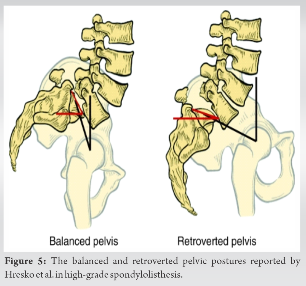 Philosophies and Surgical Techniques for High-Grade Spondylolisthesis ...