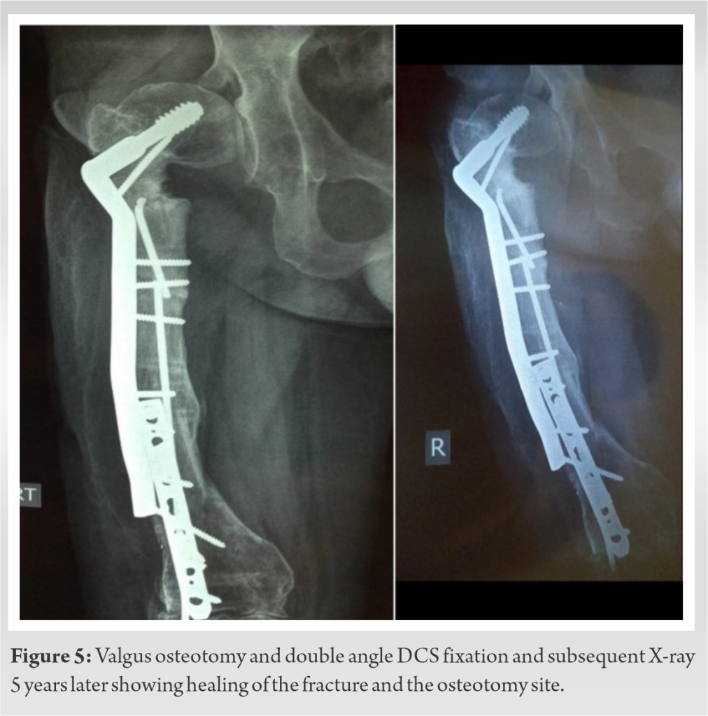 A Closer Look at Fibrous Dysplasia Femur Fracture Five-year Follow-up ...
