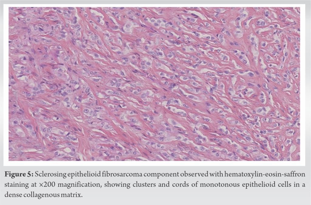 A Rare Coexistence of Hybrid Tumor Low-grade Fibromyxoid Sarcoma ...