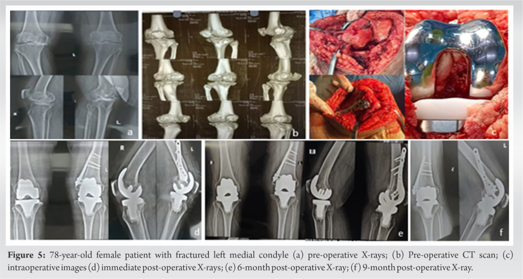 Computer Navigation-assisted Bilateral Total Knee Arthroplasty with ...
