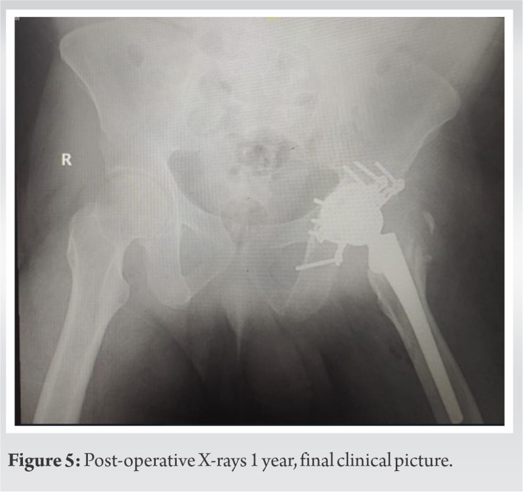 Neglected Posterior Dislocation Hip Post Acetabulum Fixation: Case ...