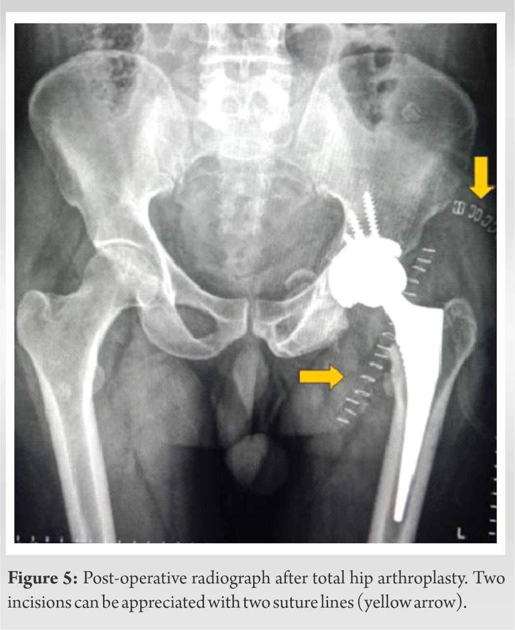 Neglected Anterior Dislocation of Hip Managed with Total Hip ...