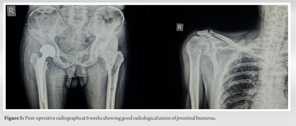 Atypical Presentation of Multiple Myeloma Affecting Appendicular ...