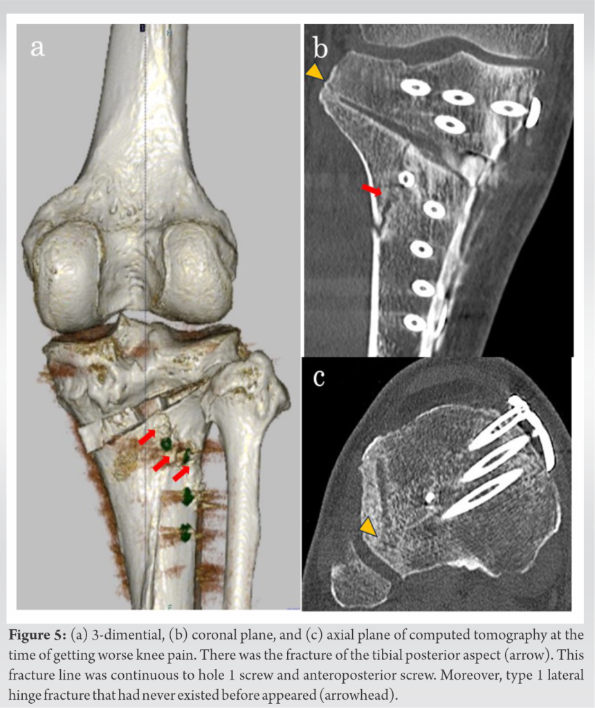 Posterior Aspect Fracture of Tibia after Open Wedge Distal Tuberosity ...