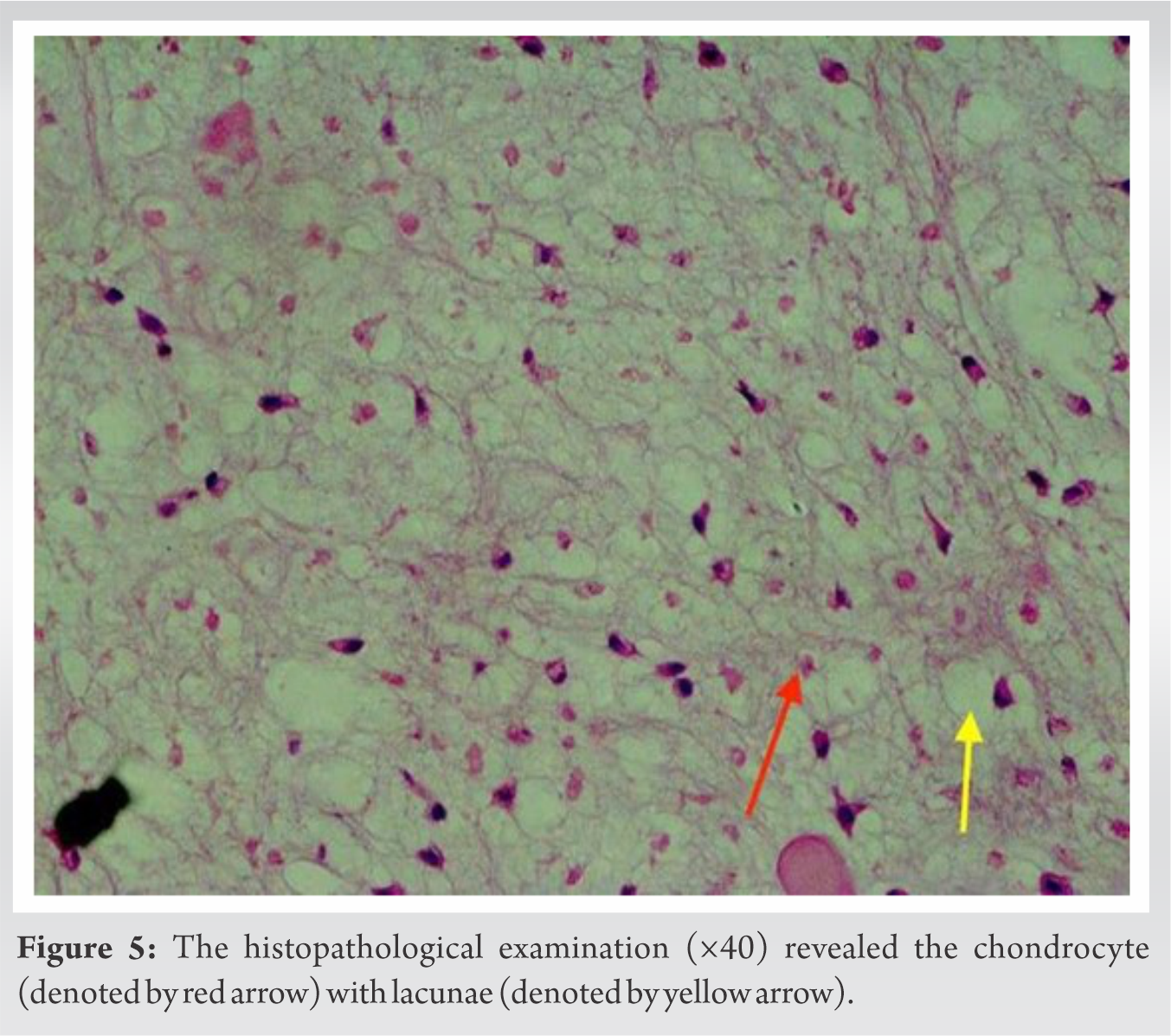 Atypical Location of Enchondroma and its Management – A Case Report ...