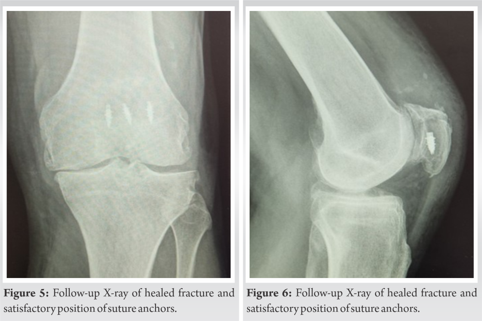 Patella Fracture Fixation Technique with Suture Anchors | Journal of ...