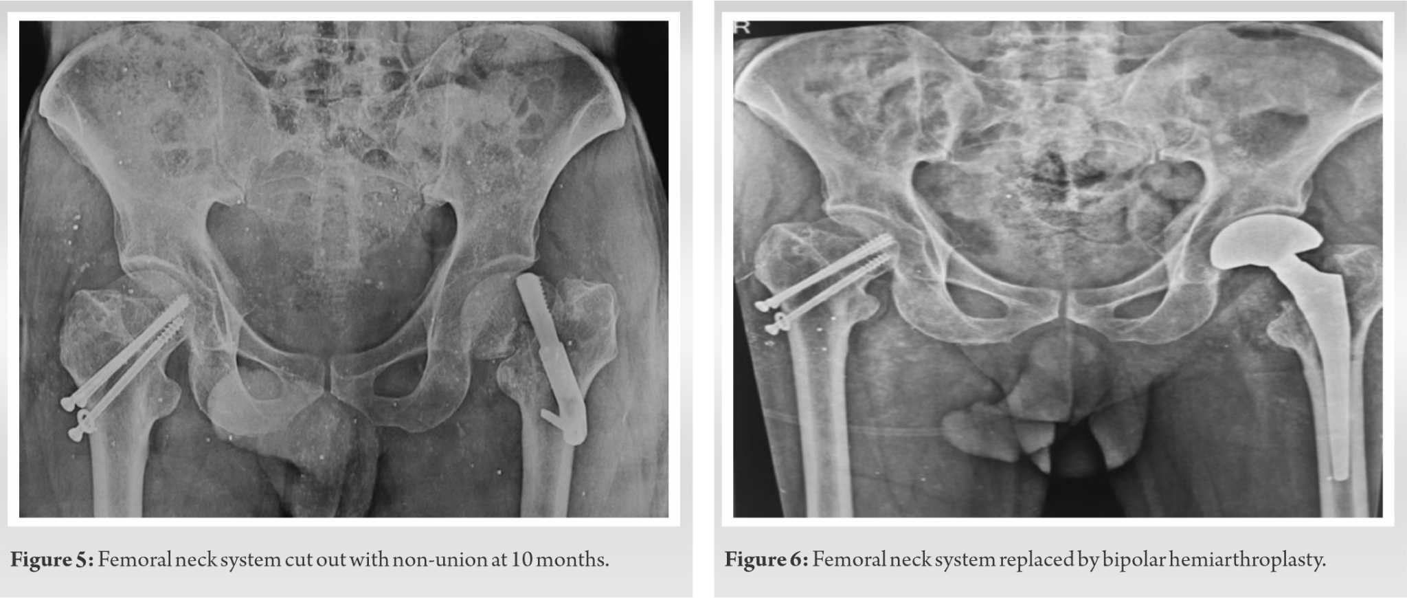 Limitations and Complications in Treating Femoral Neck Fractures with ...