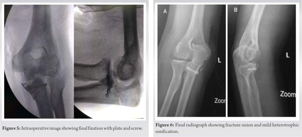 Irreducible Complex Posterior Elbow Dislocation with Varus ...