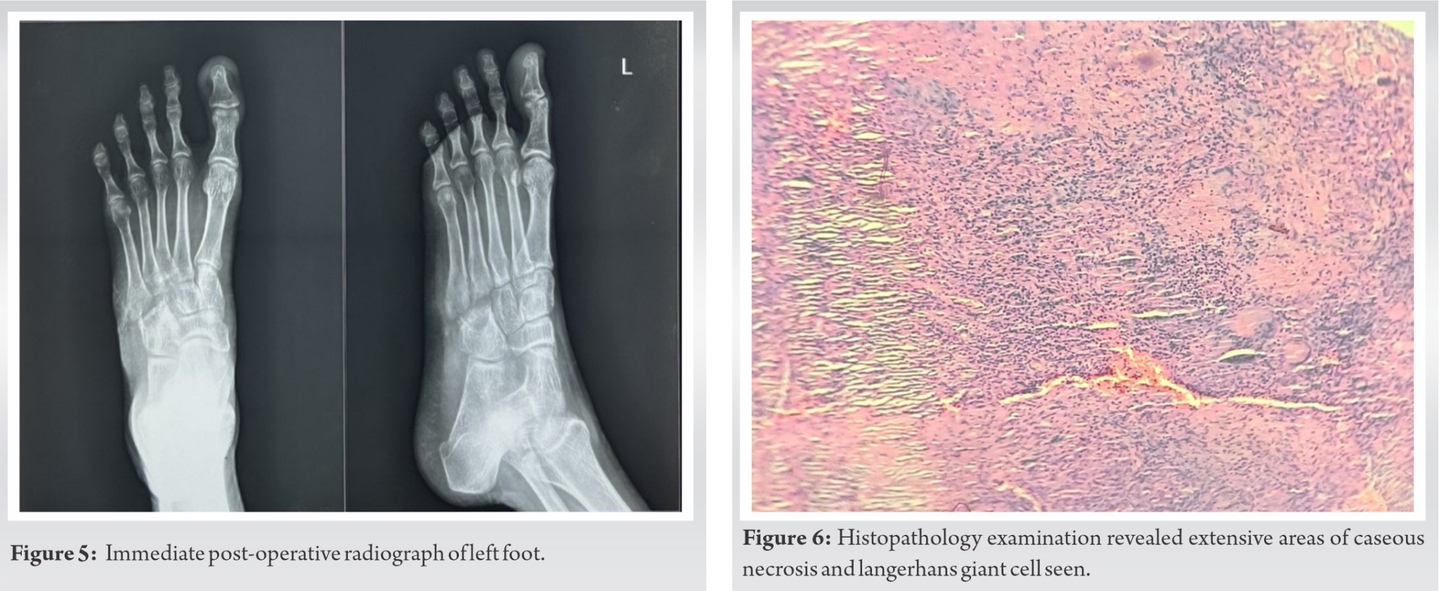 Chronic Tuberculous Osteomyelitis of Cuboid: A Case Report | Journal of ...