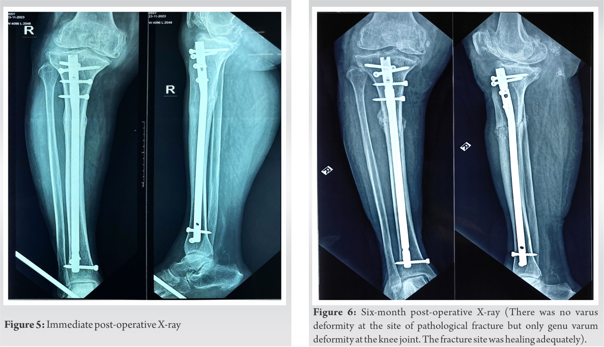 Avascular Necrosis of Proximal Tibia Associated with Pathological ...