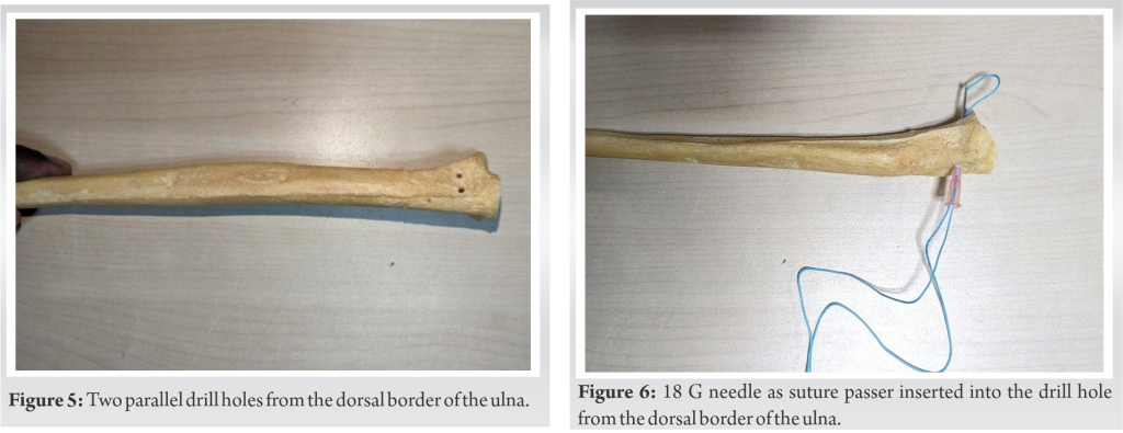 Suture Fixation of Coronoid Fractures – Using an 18 g Needle as Suture ...