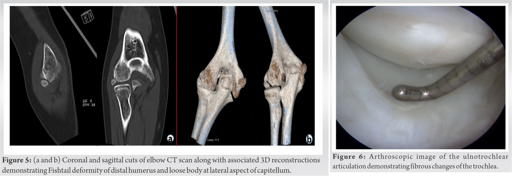 Fishtail Deformity after Type 2 Supracondylar Humerus Fracture with ...
